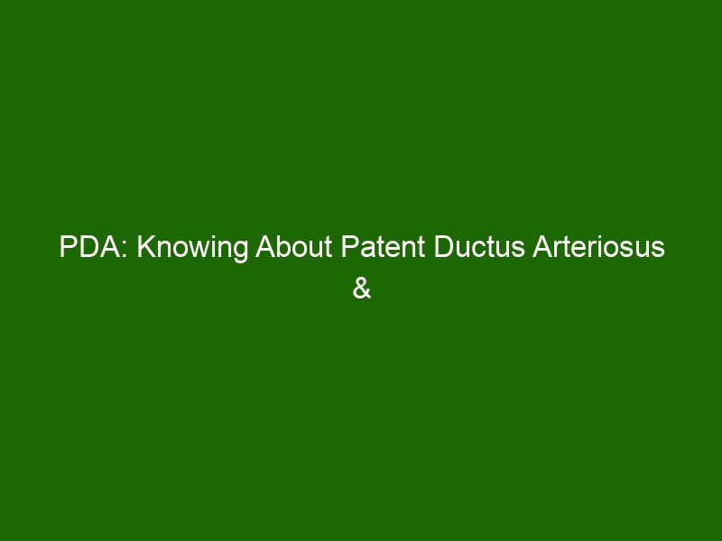 PDA: Knowing About Patent Ductus Arteriosus & Treatments Available ... PDA: Knowing About Patent Ductus Arteriosus & Treatments Available ...